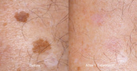 Skin Pigmentation Treatment Orlando, FL