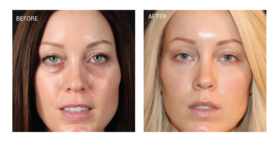 PRF Under-Eye Rejuvenation in Orlando | Gentle Touch MediSpa