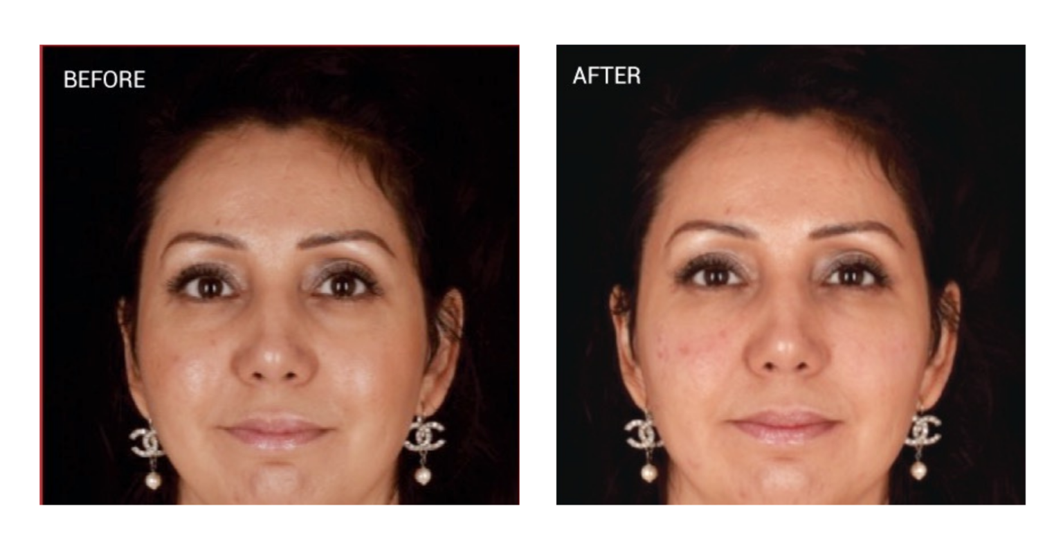 PRF Under-Eye Rejuvenation in Orlando | Gentle Touch MediSpa