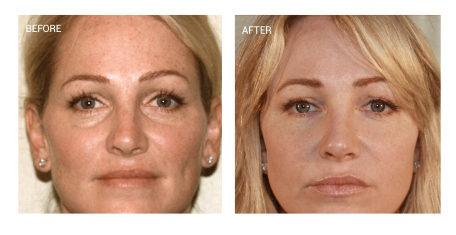 PRF Under-Eye Rejuvenation in Orlando | Gentle Touch MediSpa